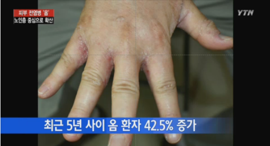 옴증상 초기 사진 옴 진드기 물린자국 사진 네이버 블로그