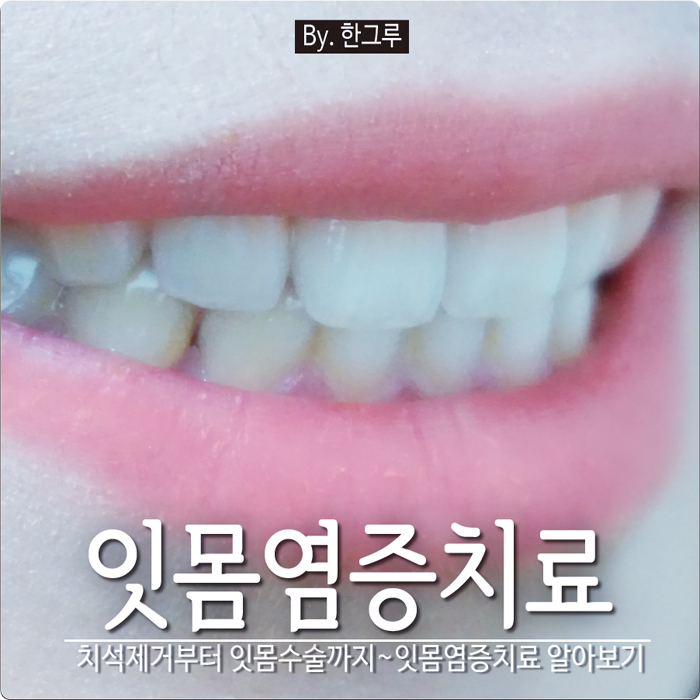 잇몸염증치료 스케일링부터 치주염치료까지 네이버 블로그
