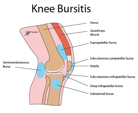 재활의학 무릎슬관절 주위의 점액낭염 Knee Bursitis 네이버 블로그