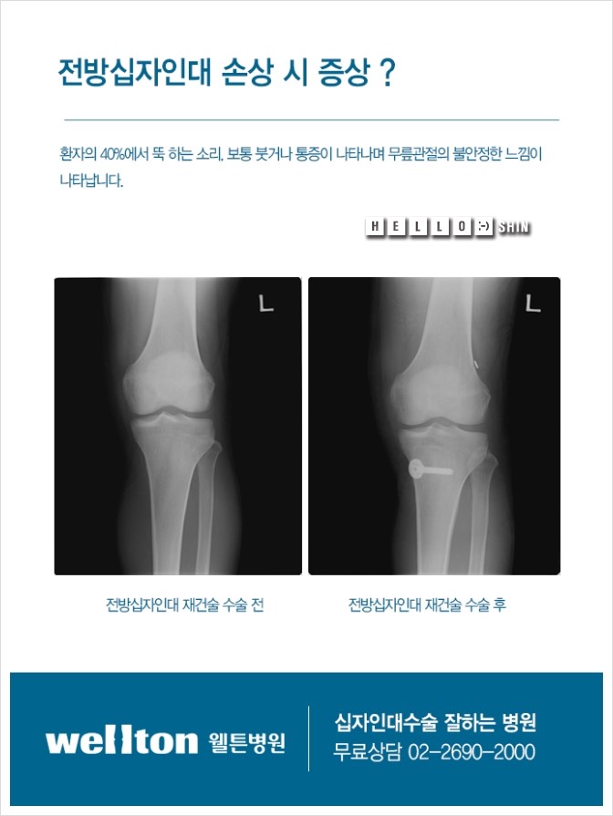 무릎수술의 종류 십자인대파열과 반월상연골파열의 차이점 무릎연골수술 수술방법과 치료과정 네이버 블로그