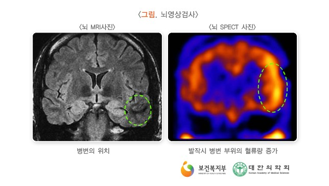 뇌전증 진단을 위한 뇌파검사란 네이버 블로그
