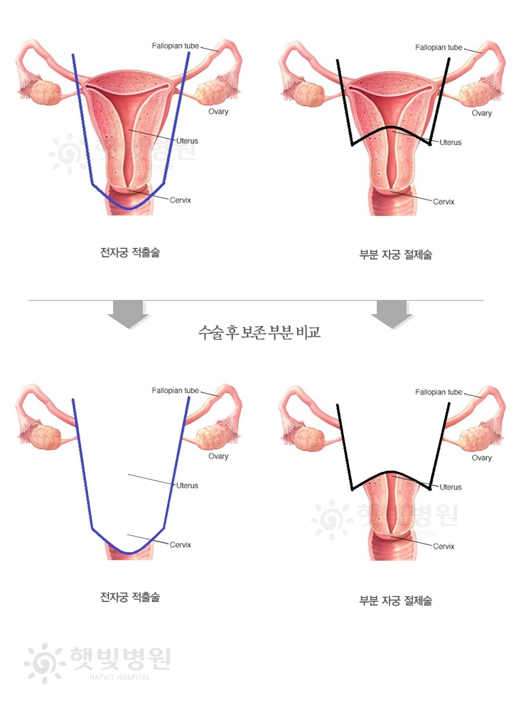 자궁적출 최선 일까 단일공복강경 1500례 성공 이현철 원장님 햇빛병원자궁수술부분자궁적출자궁근종자궁경부암자궁