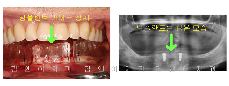 덴티움 임플란트와 로케이터 어태치먼트를 이용한 아래턱 임플란트 지지 완전틀니오버덴쳐 네이버 블로그
