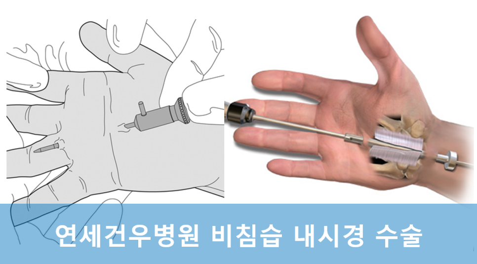 손가락통증과 구부러져 펴지지 않는 방아쇠수지증후군 수부외과병원의 치료는 네이버 블로그