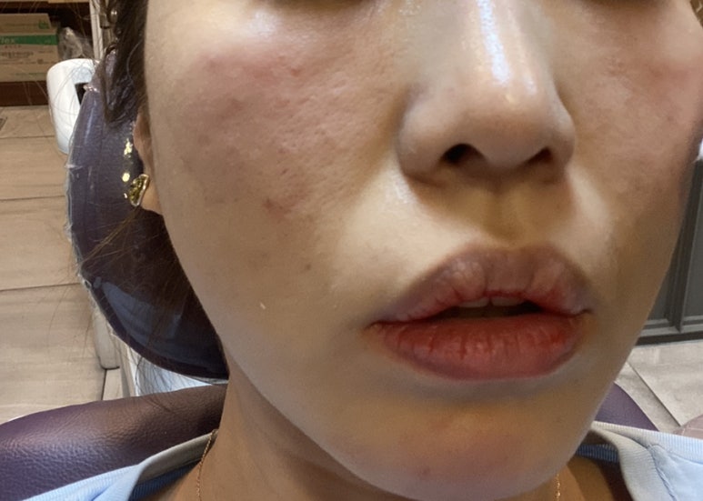 스킨부스터 리쥬란힐러 경과후기 엑소좀vs리쥬란 비교 Ft홍대피부과 네이버 블로그