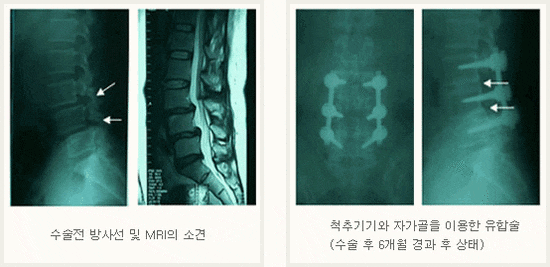 척추디스크 디스크수술 중 후방요추유합술이란 네이버 블로그