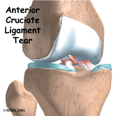 전방십자인대 손상(Anterior Cruciate Ligament Injuries) : 네이버 블로그