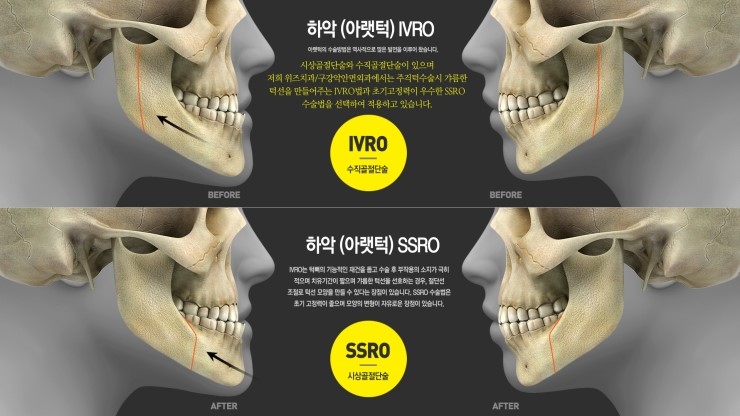 안면비대칭 - IVRO? SSRO? : 네이버 블로그