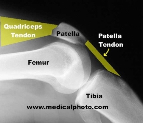 Quadriceps Tendon Tear Orthoinfo Aaos