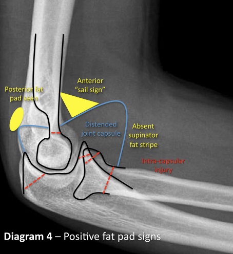 Elbow X-ray의 Fat pad sign : 네이버 블로그