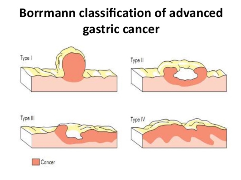 Early gastric cancer and advanced gastric cancer, classification : 네이버 블로그