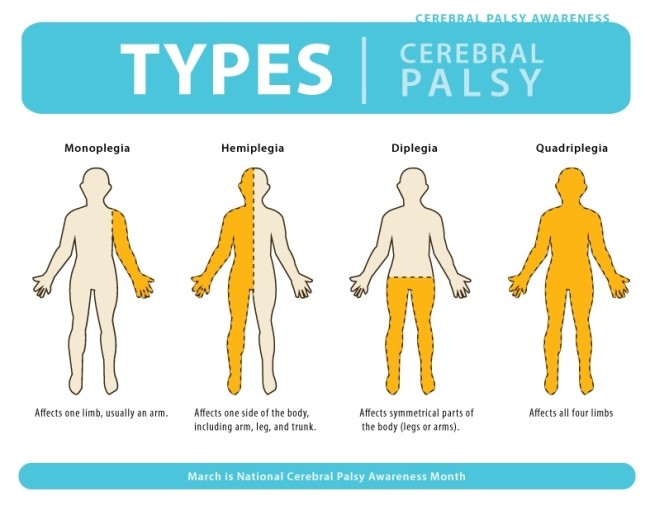 뇌성마비(Cerebral palsy) : 어린 아이에서 뇌의 결함이 있어서 정상적인 운동이 안되고 자세가 이상해요 : 네이버 블로그