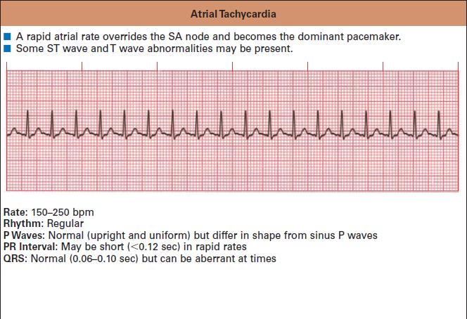 Atrial arrhythmia, Atrial premature contraction, 심방조기수축, Atrial ...